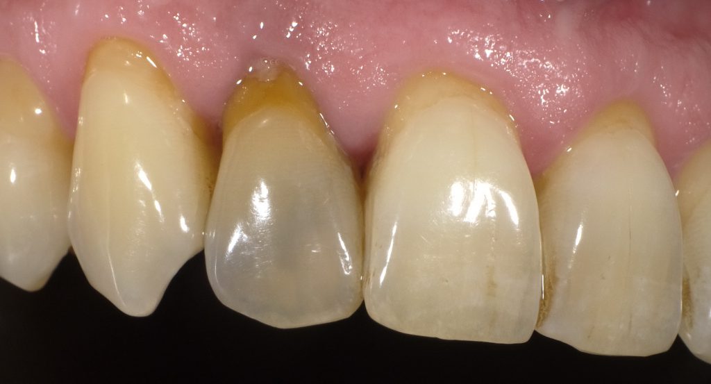 Bleichen Zähne Bleaching Zahnarztpraxis Zahnarzt Dr. Misovic - Misovic